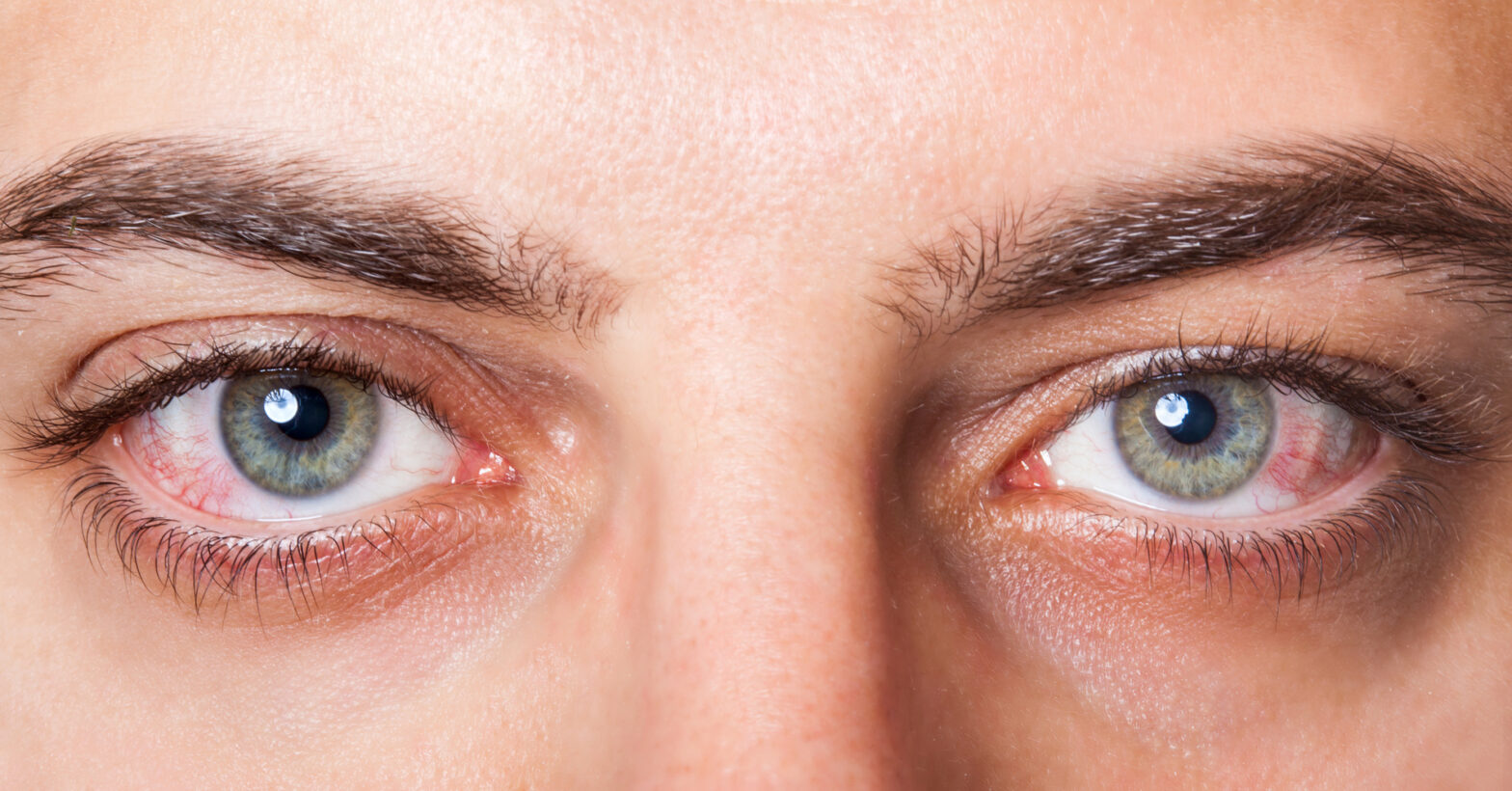 Red Eyes - Boerne Vision Center