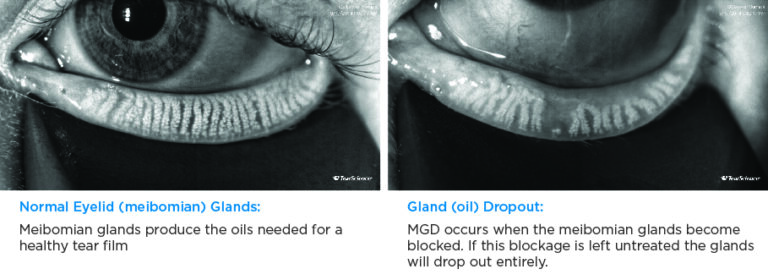 Dry Eye or MGD? - Boerne Vision Center