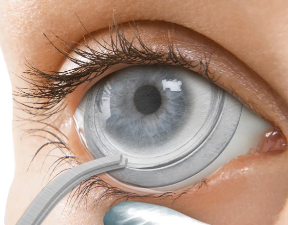 PROKERA® Biologic Corneal Bandage - Boerne Vision Center