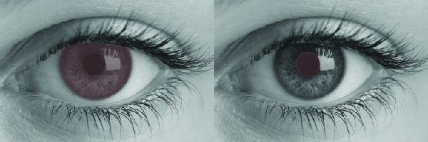 Assisting Patients With Migraines, Headaches, Blepharospasm, & Other ...